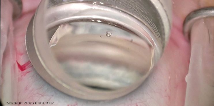 Surgical gonio prism